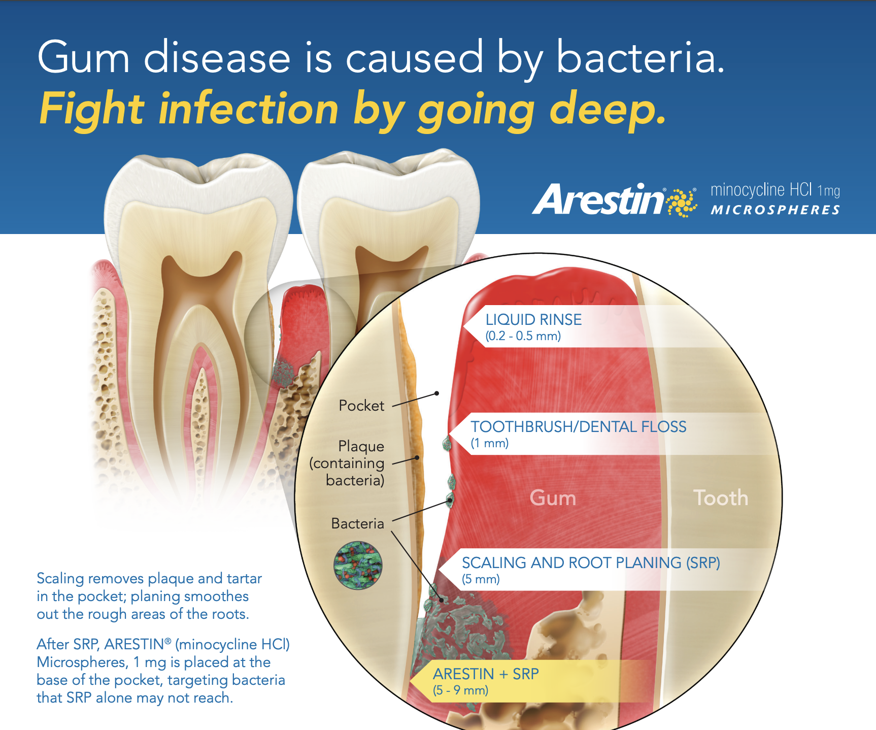 Non-Surgical Periodontal Treatment | Brier Creek
